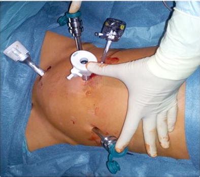 Position Of Ports For The Procedure Download Scientific Diagram