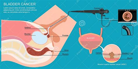 Cystoscopy Enables The Inside Of The Urethra And Bladder To Be Examined