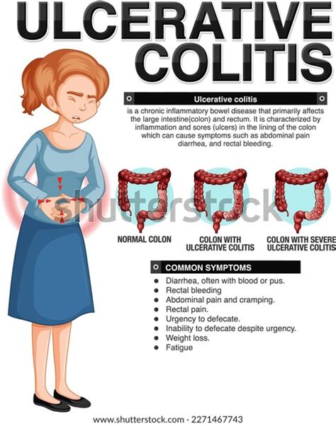 Ulcerative Colitis Symptoms Infographic Illustration Stock Vector