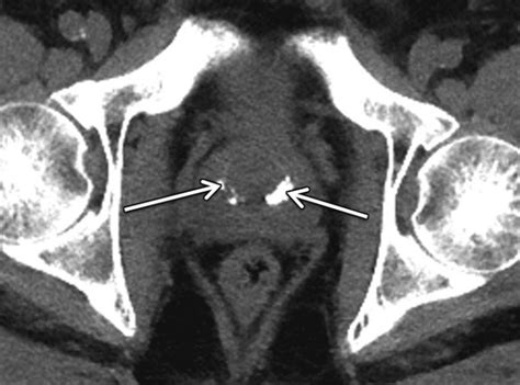 Comment Traiter La Calcification De La Prostate Information Hospitalière Lexique Et