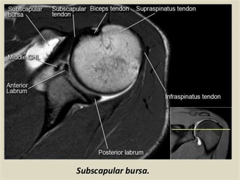 Mri Musculo Skeletal Section Bursa Of Shoulder