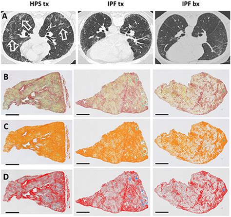 Frontiers Automated Digital Quantification Of Pulmonary Fibrosis In