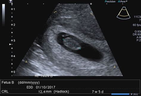 Icd 9 Dichorionic Diamniotic Twins