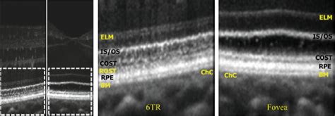 41 Visualization Of Outer Retina By Ao Oct System Four Outer Retinal Download Scientific
