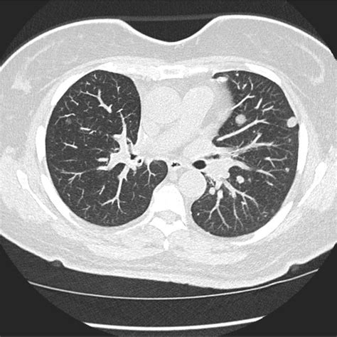 Ct Image Demonstrating Pulmonary Nodules Download Scientific Diagram