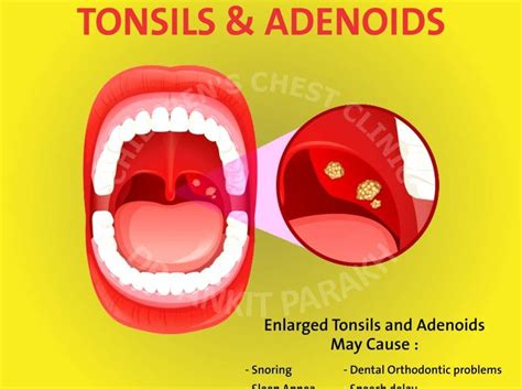 Common Side Effects Of Anti Tuberculosis Tb Medicines Dr Ankit
