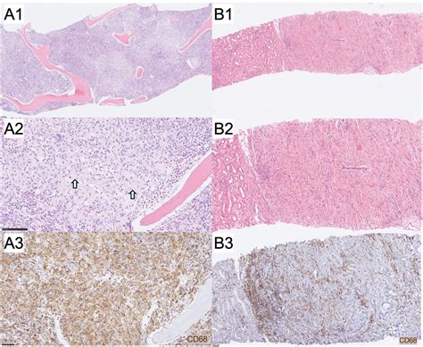 Erdheim Chester Disease In Adults 11 Cases From A Canadian Rare