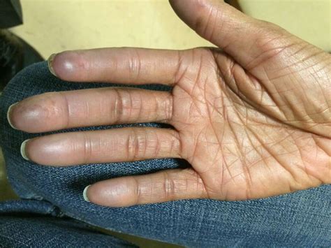 Scleroderma 10 Scleroderma Symptoms