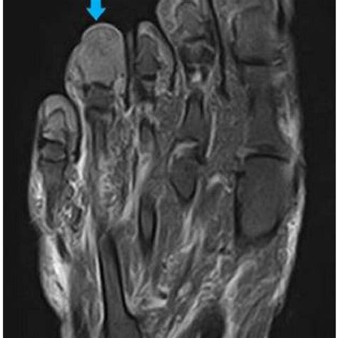 Coronal View On The Mri T2 Stir Sequence Visualizing The Mass On The