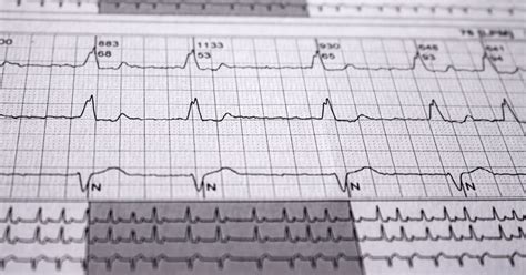 Persistent AFib Breakthrough Cardiac Wire