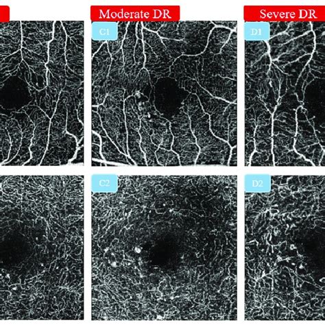 Examples Of A Series Of 3 × 3 Mm 2 Superficial Capillary Plexus Scp Download Scientific