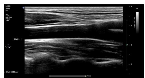 Intima Medial Thickness IMT Measurement Approximately 1 Cm Before The Download Scientific