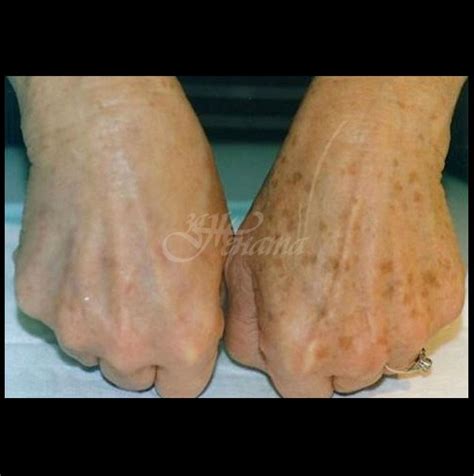 Домашна маска за премахване на старчески петна от ръцете За Жената