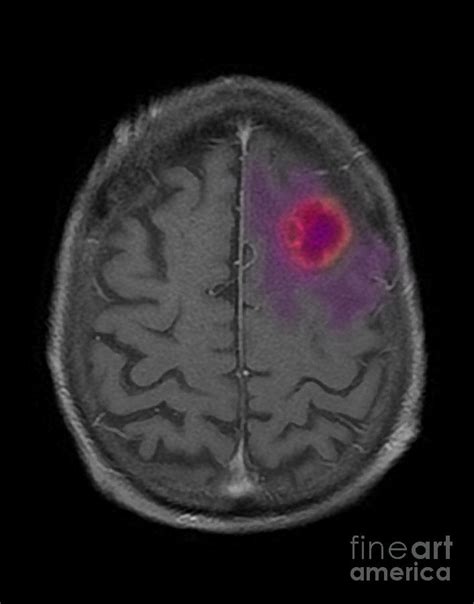 Mri Of Encapsulated Abscess In Frontal Photograph By Scott Camazine