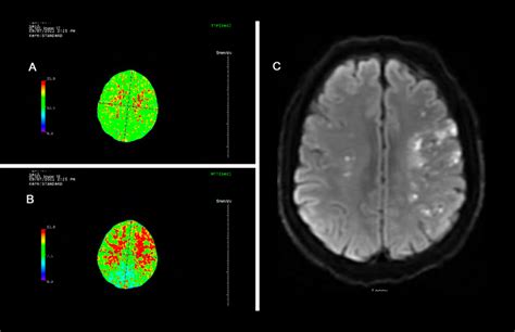Panel A And B Demonstrate Prolonged Time To Peak Ttp And Mean Transit Download Scientific