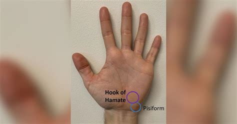 Hook Of Hamate Fracture Excision Seen As A Preferred Option In Athletes