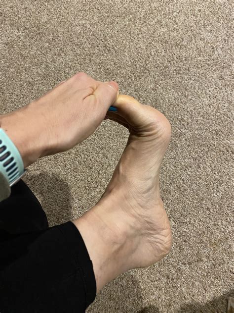 Running With Plantar Fasciitis What A Pt Wants You To Know Relentless Forward Commotion