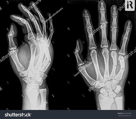 X Ray Image Of Broken Hand Ap And Oblique View Show Metacarpal