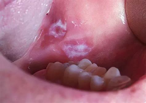 Oral Leukoplakia Symptoms And Treatment Healthy Food Near Me