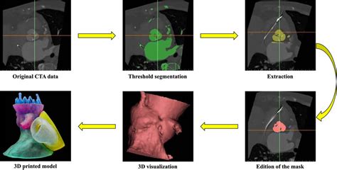 The Main Process Of 3d Printed Aortic Root Models Download