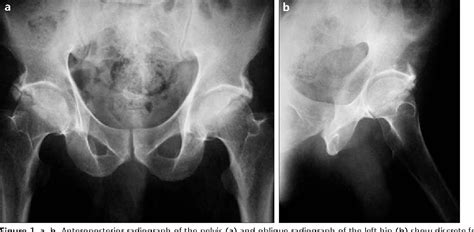Figure 1 From Idiopathic Bilateral Acetabular Labral Ossification Semantic Scholar