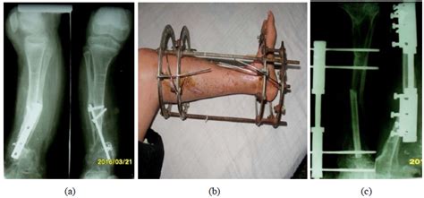 Treatment Of Large Bone Defect Of Long Bones Comparison Of Free