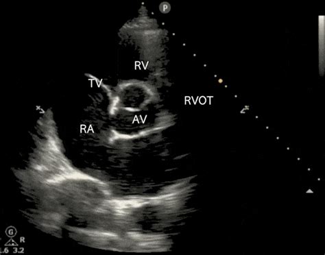 Aortic Valve Echo