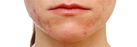 Common Acne Myths Dr Maral Skelsey