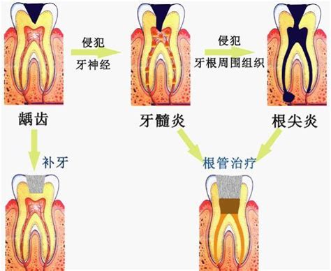 牙髓炎该怎么治疗呢 爱康健齿科