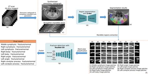 The Pipeline Of Our Proposed Mandibular Fracture Detection Method Download Scientific Diagram