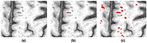 Visual Comparison Of The Pvs Segmentation Overlaid On T1 A Using The