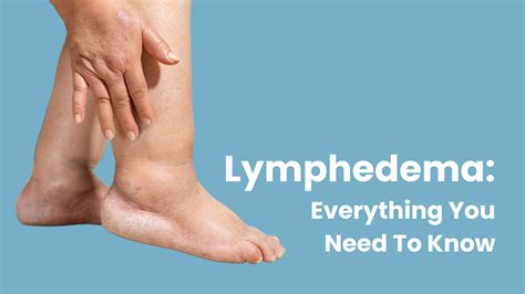 Lymphedema Causes Symptoms Diagnosis And Treatments