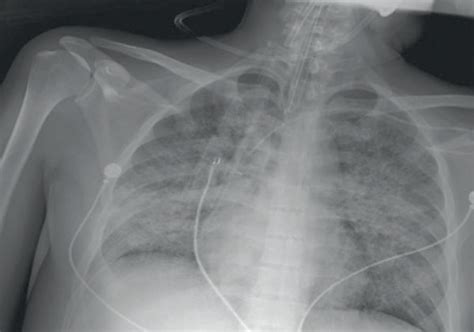 Chest X Ray With An Extensive Nodular Pattern In Both Lung Fields