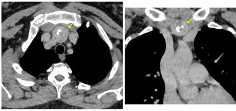 Ectopic Mediastinal Thyroid A Crossroad Between A Multi Layered Endocrine Perspective And A