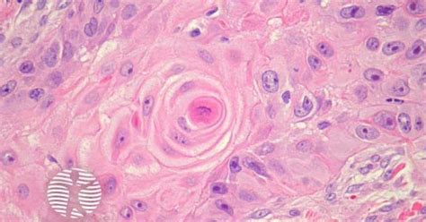 Moderately Differentiated Squamous Cell Carcinoma Pathology Image