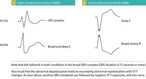 figure 3 this figure illustrates ecg patterns in lbbb and rbbb as