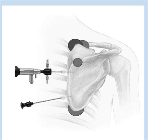 Figure 3 From Clinical Management Of Scapulothoracic Bursitis And The Snapping Scapula