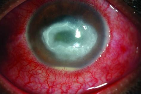 Acanthamoeba Keratitis Eyewiki