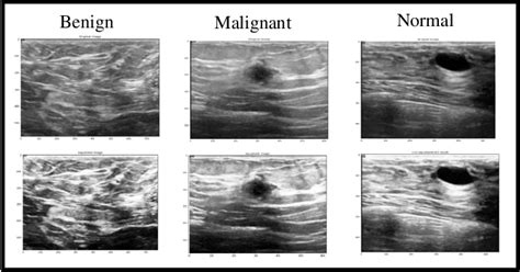 Figure 5 From Breast Cancer Segmentation Using Attention Based Convolutional Network And