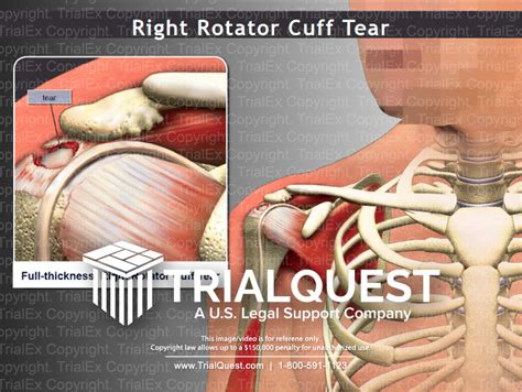 Rotator Cuff Tear Of Right Shoulder Icd 10 At John Miguel Blog