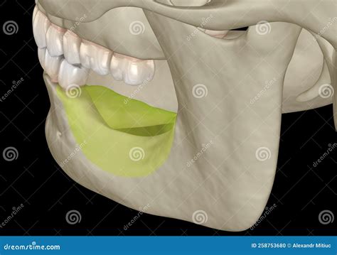 Mandibular Jaw Bone Recession After Losing Molars Teeth Medically