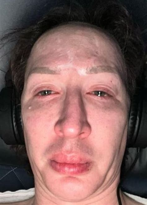 Sore After Using Tret Rtretinoin