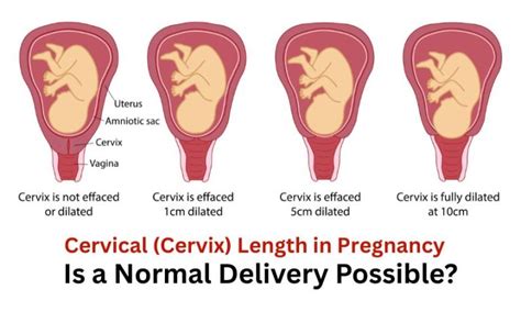 Cervical Cervix Length In Pregnancy Is A Normal Delivery Possible