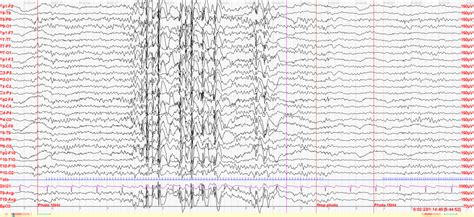 Eeg Centrum Pro Epilepsie Brno