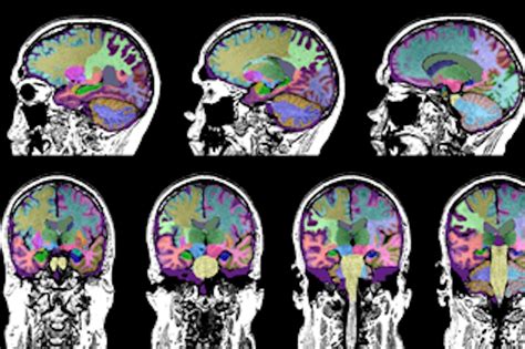 Healthy Brain Scan