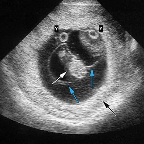 Dating Twin Pregnancy By Ultrasound Telegraph