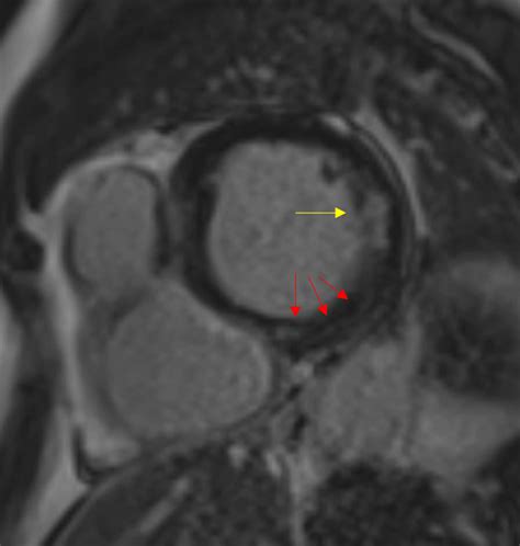 Cardiac Magnetic Resonance Image Showing Subendocardial Lateral Download Scientific Diagram