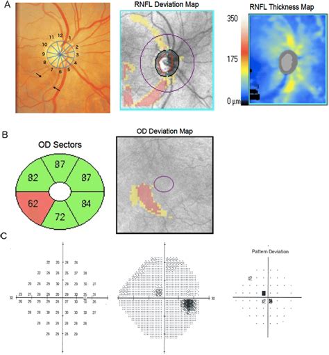 Example Of A Glaucomatous Eye With A Localized Retinal Nerve Fiber Download Scientific Diagram