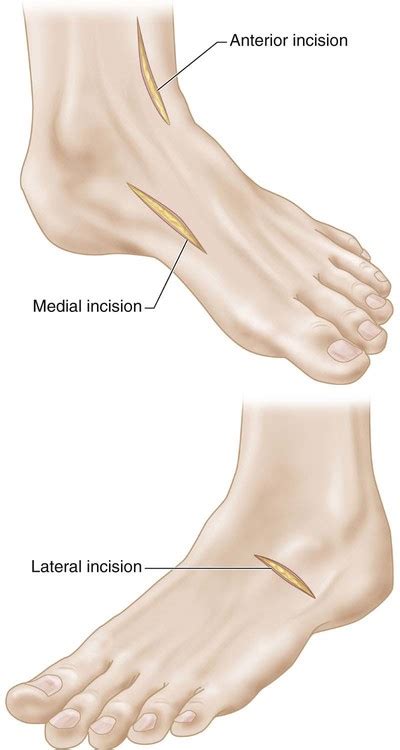 52 Split Transfer Of The Tibialis Anterior Tendon Musculoskeletal Key