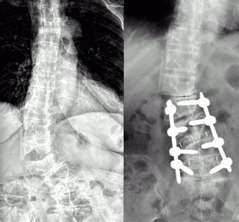 Olif手術—退化型脊椎側彎 微創脊椎關節張建鈞醫師手術團隊